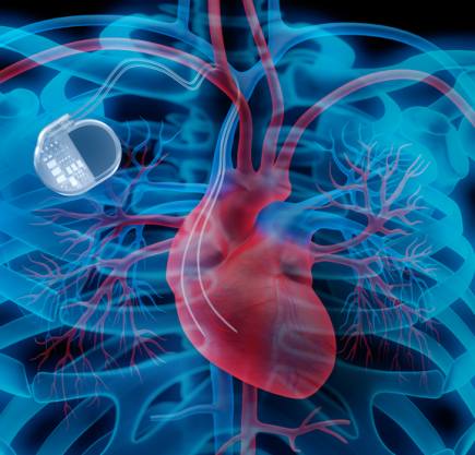 A case of cardiac perforation – itjem